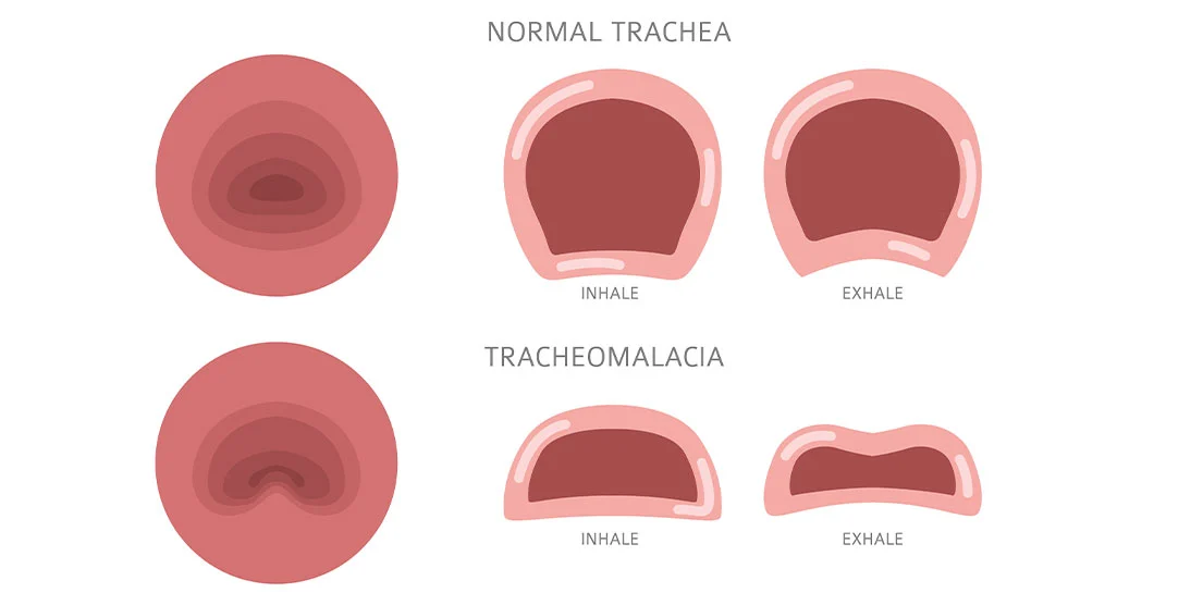 Traqueomalacia – Clínica Marco Rived